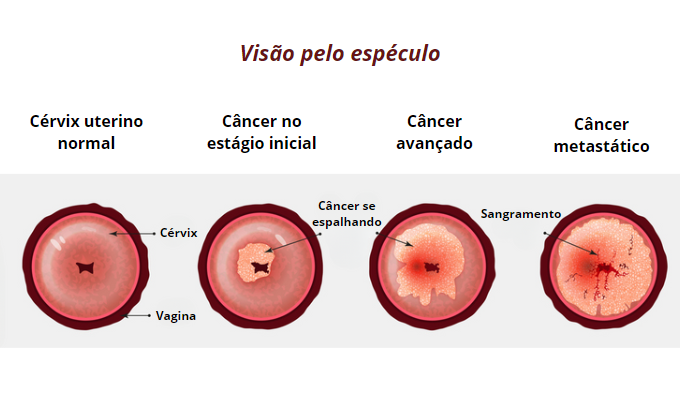 Dot.Lib - Março lilás: campanha contra o câncer do colo do útero Dot.Lib - Março lilás: campanha contra o câncer do colo do útero